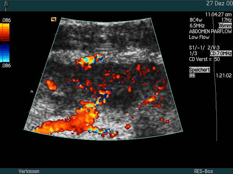 renal transplant